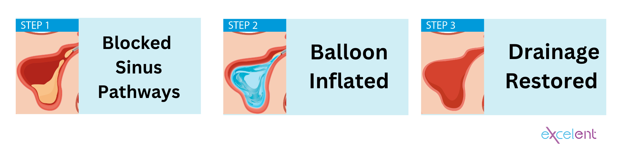 Balloon Sinuplasty - ExcelENT