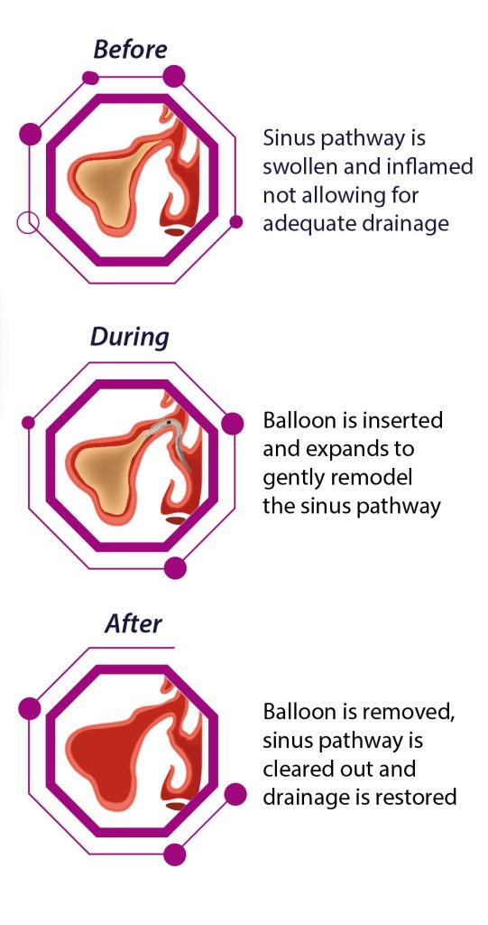 Learn More About Sinusitis: Causes, Symptoms, and Treatments | excelENT ...